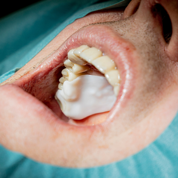 Elemental Oral Surgical Granulates - Swallow Dental