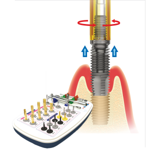 Dental Implant Care - Swallow Dental